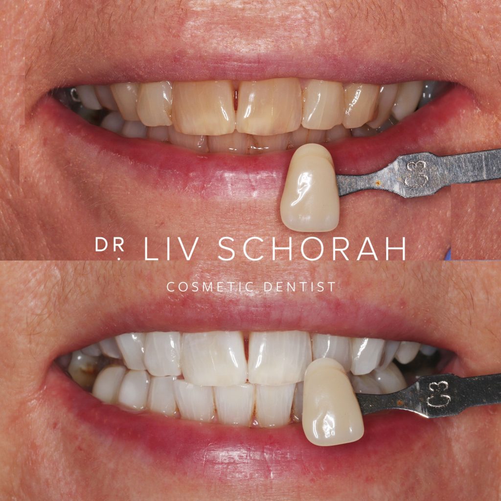 Teeth Whitening | Leeds | Garforth | Enhance Dental Enhance Dental