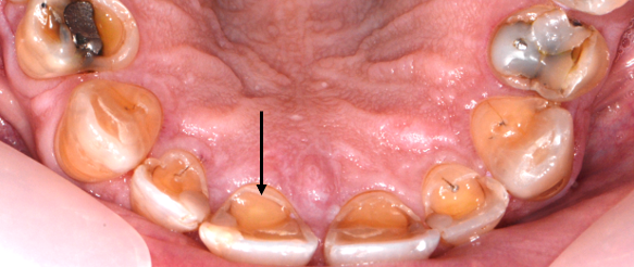 Toothwear - Learn more with Dr Tom Dobson Enhance Dental